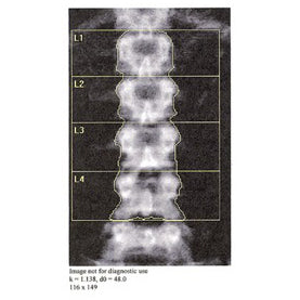 Bone Density Testing - The Good, the Bad and the Ugly - Dr. Lani Simpson